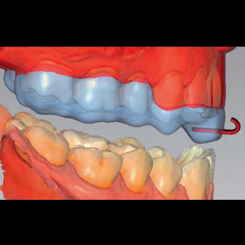 Anti Snoring Splint Design (Serenight ©) - Switzerland Only - Swiss 3D ...
