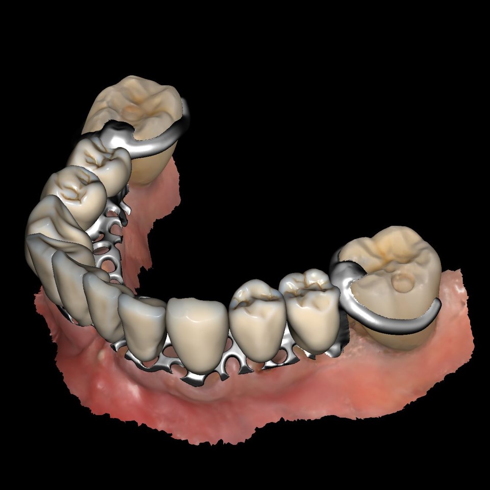 Quick Snap : Partial Framework + teeth + gingiva design - Swiss 3D ...