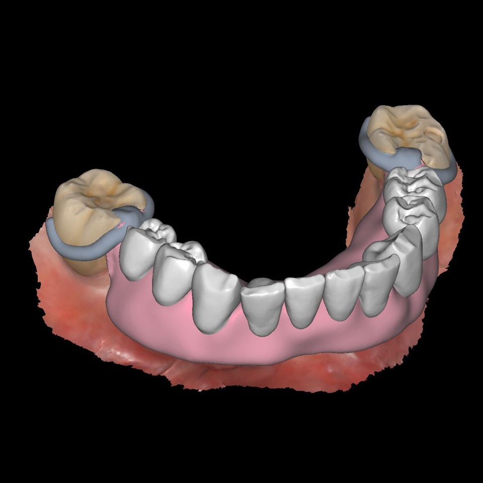 Partial Framework Design - Swiss 3D Dental Design