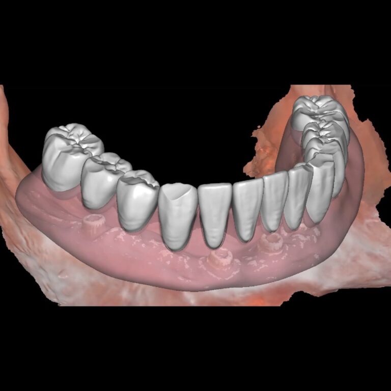 Full Denture upper / lower jaw - Swiss 3D Dental Design