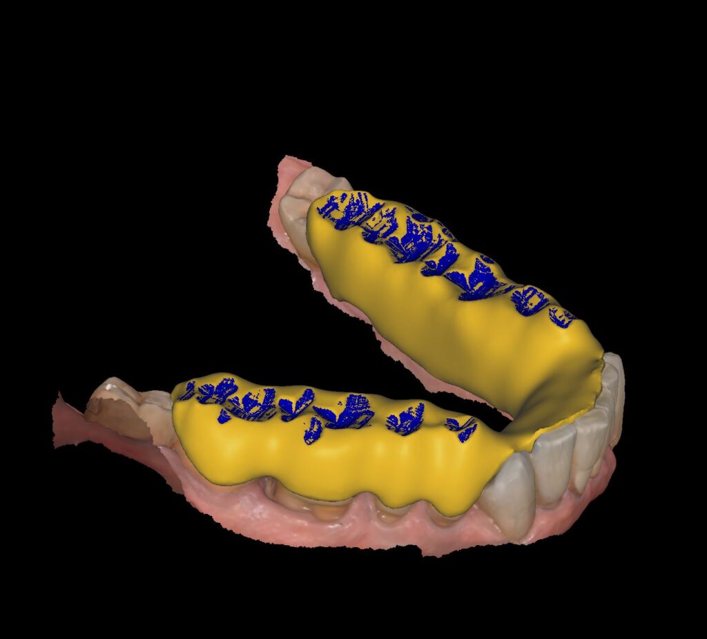 Gelb Splint - Swiss 3D Dental Design